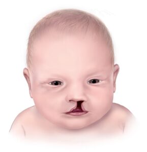 What are Cleft and Craniofacial Conditions? - AmeriDisability